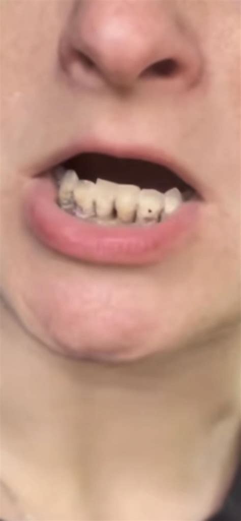 Her Bottom Teeth Have Deteriorated Really Fast Rashleystarrcasteel