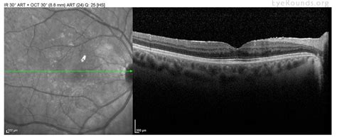 Behcets Disease A 32 Year Old Female With Recurrent Ocular Inflammation