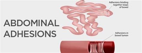 Abdominal Adhesions Causes Symptoms And Treatment Netmeds