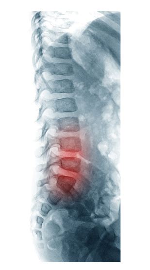 X 선 영상 Lumbosarcal 척추 X 레이에 대한 스톡 사진 및 기타 이미지 X 레이 건강 진단 건강관리와 의술
