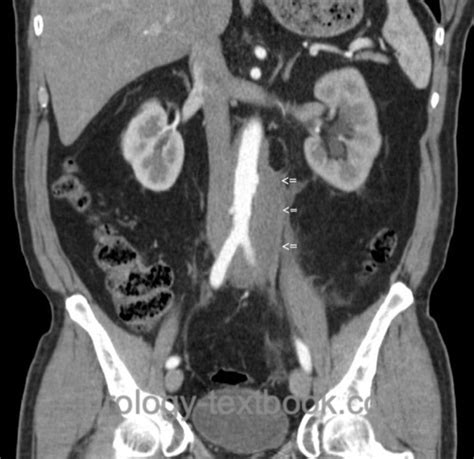 Retroperitoneal Fibrosis Ultrasound