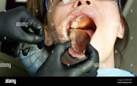 Examination Oral Cavity With Retractor And Mirror Maxillary Molar Missing Female Patient In
