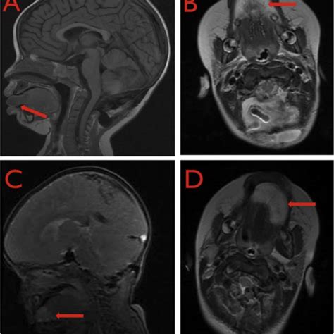 Case 2 Severe Macroglossia After Craniofacial Surgery Le Fort Iii Download Scientific Diagram