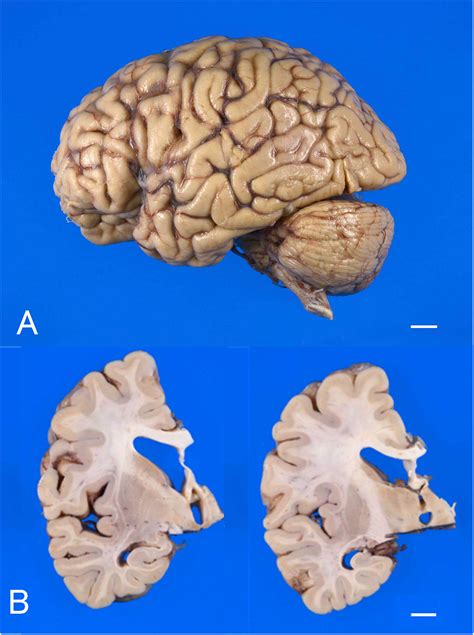 Creutzfeldt Jakob Disease Brain