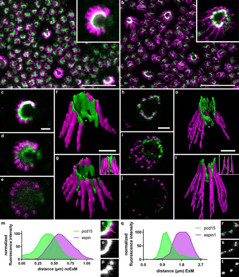 High Magnification Of Cone Calyceal Processes By Expansion