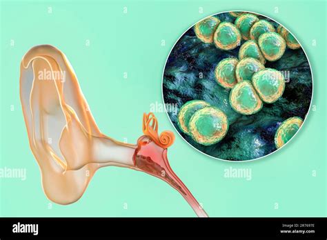 Otitis Media Infección Del Oído Causada Por La Bacteria Streptococcus
