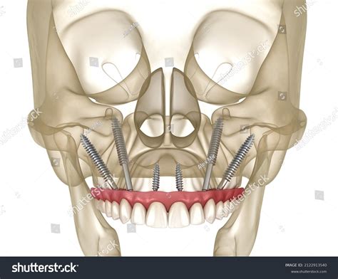 Maxillary Process Of Zygomatic Bone