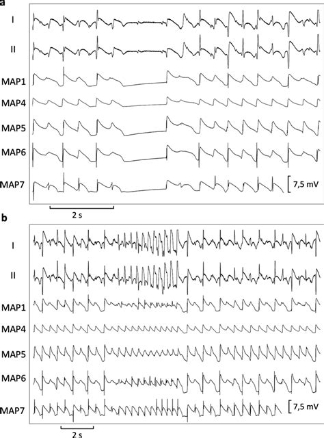 A Representative Example Of Early Afterdepolarizations A And