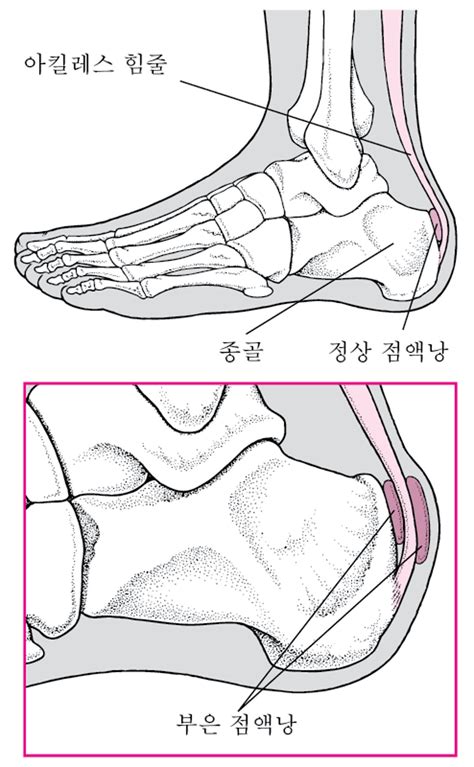 아킬레스건 윤활낭염 뼈 관절 근육 장애 Msd 매뉴얼 일반인용