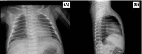Spontaneous Pneumomediastinum In A Term Neonate Case Report Pmc