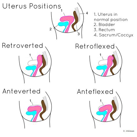 Tilted Cervix Diagram