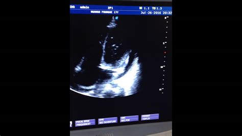 Pericarditis On Echo Youtube