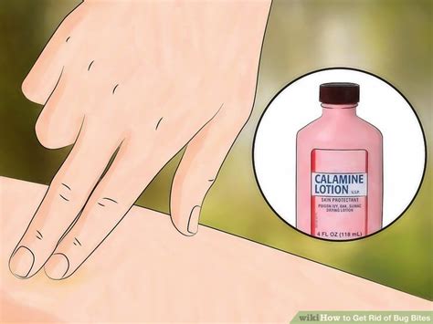 4 Ways To Get Rid Of Bug Bites WikiHow