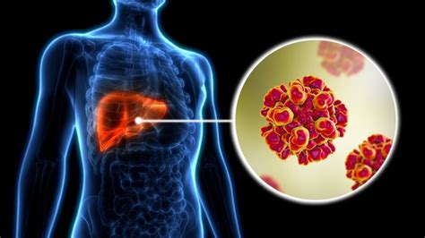 Understanding Hepatitis E And Its Common Symptoms Today