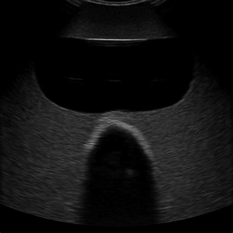 Rectal And Bladder Ultrasound Phantom Imaging Solutions
