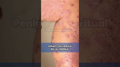 Interpretando el significado de soñar con heridas en las piernas de