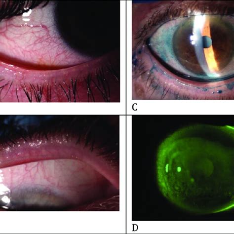 Ocular Surface Photos Demonstrating Inflammation Related To Ded A