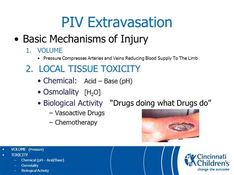 Preventing Pediatric Intravenous Extravasation Injuries Ppt Video Online Download