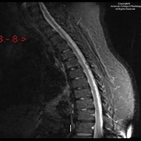 PHILIPS每日一例罕见病例 创伤性脊髓积气 MedSci cn