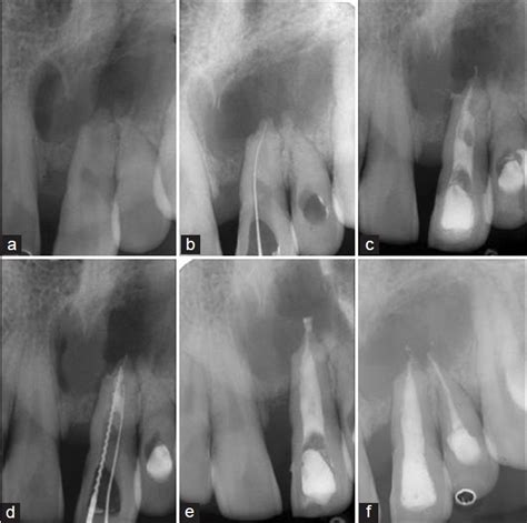 Tooth Resorption Part I Pathogenesis And Case Series Of Internal