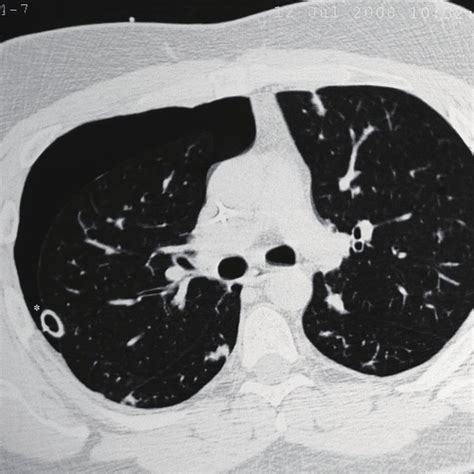 Chest X Ray Performed 24 Hours After Chemical Pleurodesis Confirms