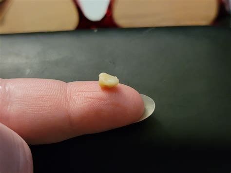 Giant Tonsil Stone