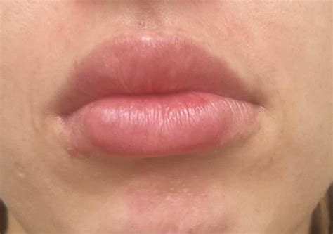 Botched Lip Filler Rcosmeticsurgery