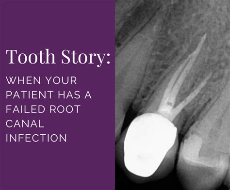 When Your Patient Has A Failed Root Canal Infection Sonia Chopra Dds