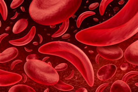 Bridging Gaps And Advancing Care In Sickle Cell Disease In The Context