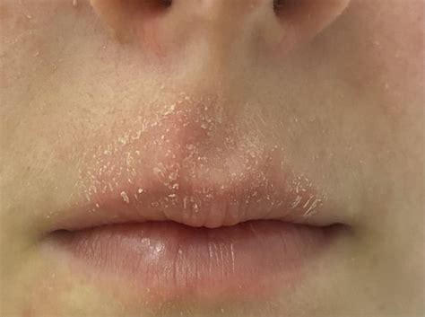 Eczematous Cheilitis Cheilitis An Overview Sciencedirect Topics