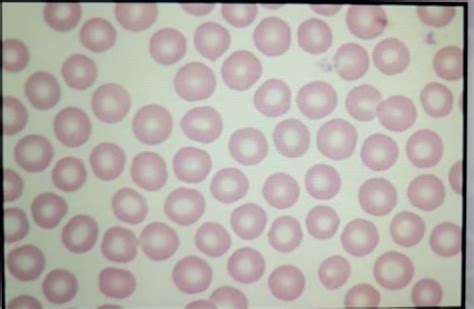 Red Blood Cell Photos Flashcards Quizlet