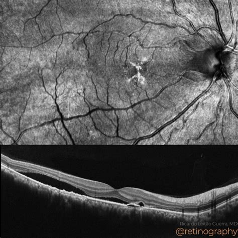 Central Serous Chorioretinopathy Retinography