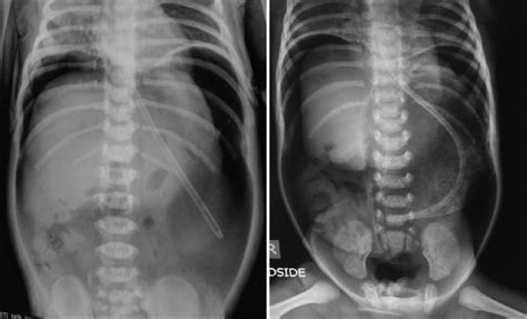 X Rays Showing Massive Pneumoperitoneum And Gastric Pneumatosis