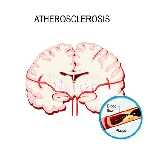 Cross Section Of The Brain Human Brain With Atherosclerosis Stock