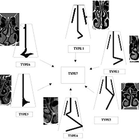 Graphically Presented Mladinas Classification Of The Septum Download Scientific Diagram