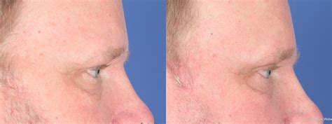Blepharoplasty Before And After 46 Weber Facial Plastic Surgery