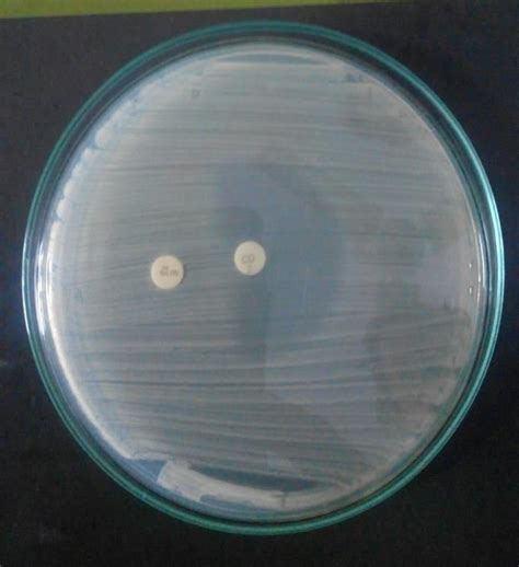 Positive D Test Showing Blunting Of Fig 2 Negative D Test Ms