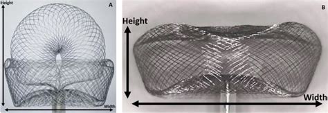 Treatment Of A Ruptured Shallow Trilobed Cerebral Aneurysm With The