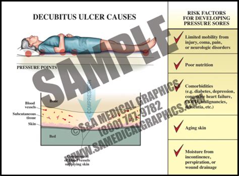 Decubitus Ulcer Formation Sanda Medical Graphics