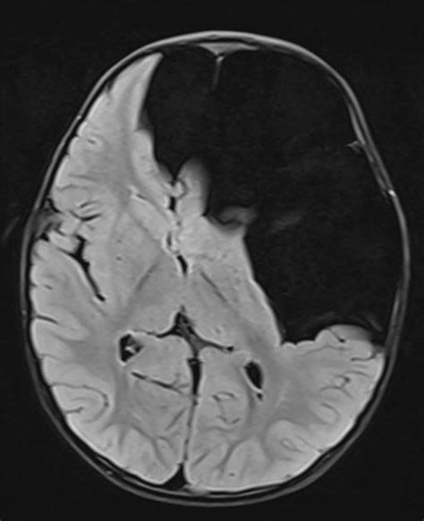 Cerebral Cavernous Venous Malformation Artofit