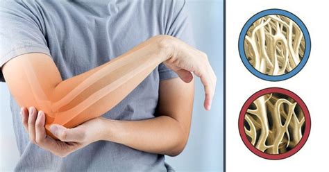 მიირთვით ყოველდღე რათა გაიმაგროთ ძვლები და თავიდან აირიდოთ ოსტეოპოროზი