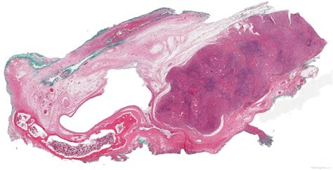 Thyroglossal Duct Cyst Atlas Of Pathology