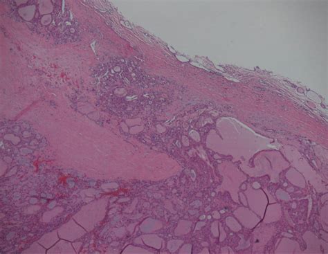 Isolated Multifocal Sclerosing Thyroiditis Case Report