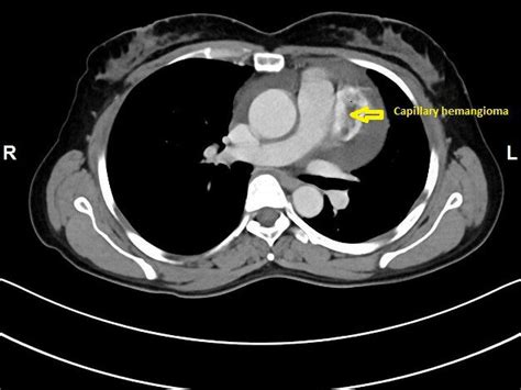 Contrast Enhanced Computed Tomography Axial Plane View Showing A