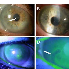 Recurrent Corneal Erosion