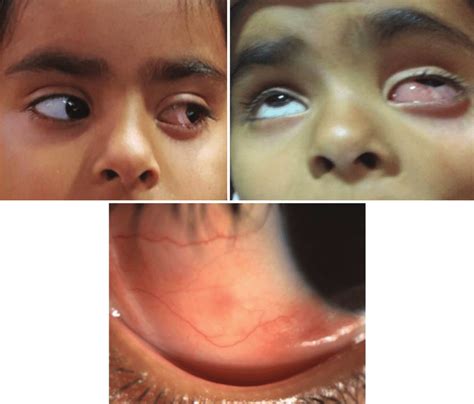 A Face Photograph Showing Redness Of The Left Eye B Showing Left A Face Photograph Showing Redness Of The Left Eye B Showing Left
