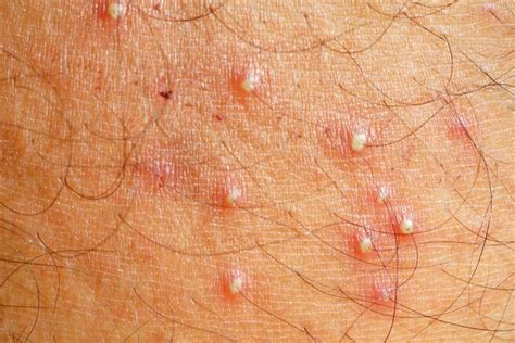 Folikulitis Nature Ace Indonesia