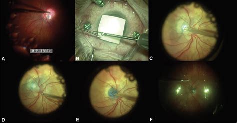 How To Manage Optic Pit Maculopathy