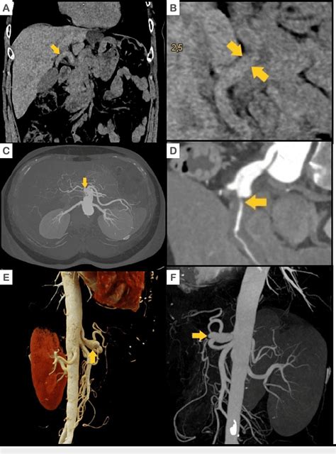 Figure 1 From A Rare Case Of Single Organ Vasculitis Of The Hepatic Artery In A Female Patient