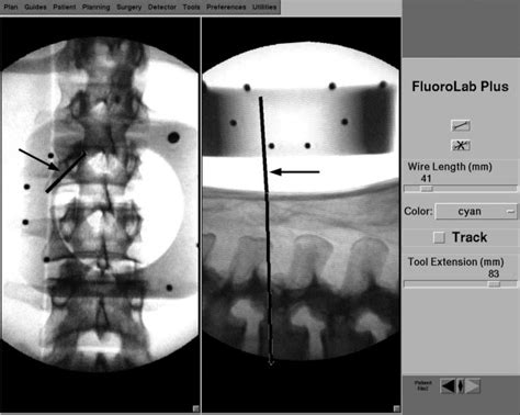 Image Guided Navigation For Cervical Spine Surgery Musculoskeletal Key